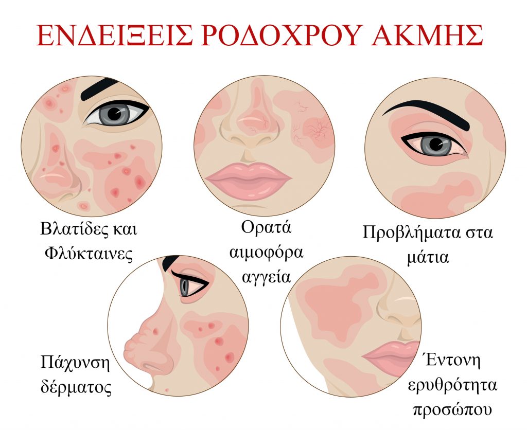 Ροδόχρους ακμή – Ιατρείο Δουλαβέρη Τζέτα